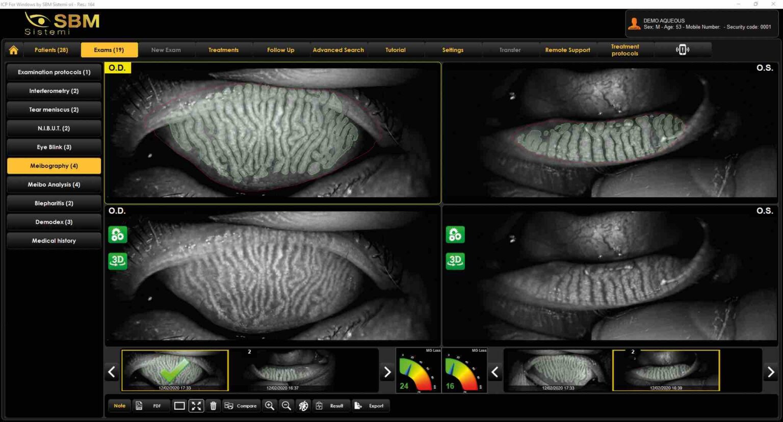 Das trockene Auge / Sicca Erkrankung